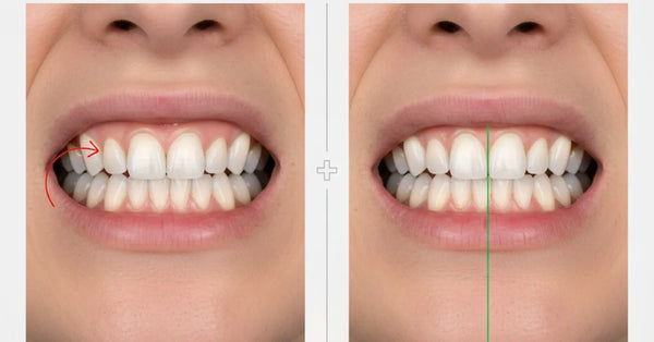Overbite Treatment & Retainer Options - NewSmile Canada