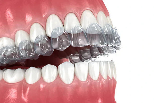 😬 Overbite Correction: Can Retainers Help? - NewSmile Canada